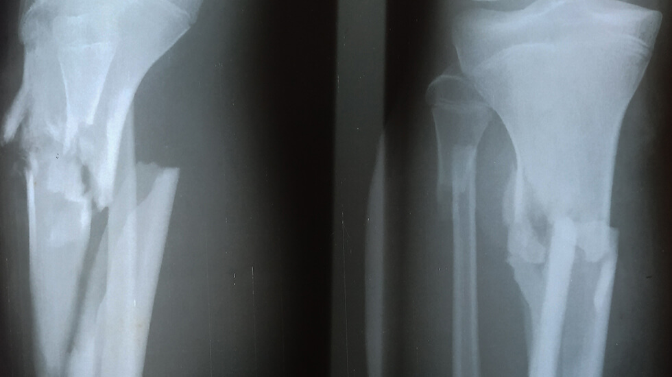 Open Tibia Fracture